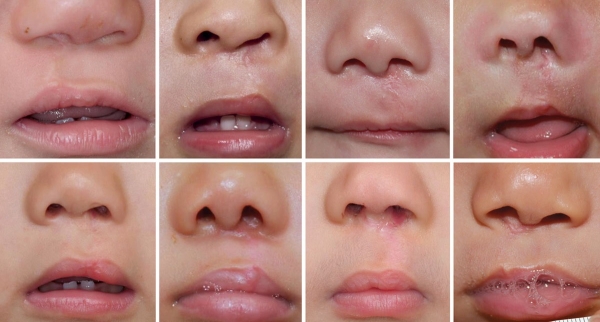 Labbro leporino, una guida completa